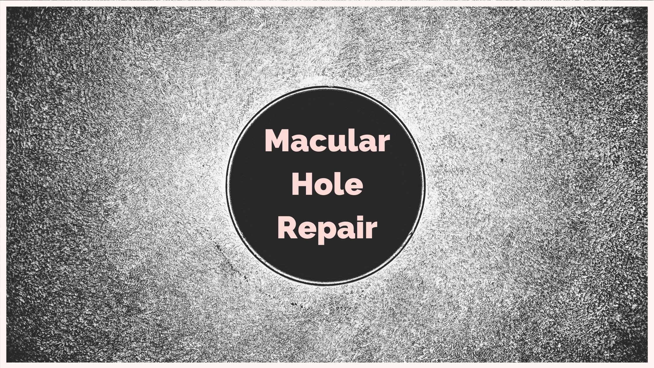 Macula Hole Repair Surgery | Dr Mulonga, Ophthalmologist