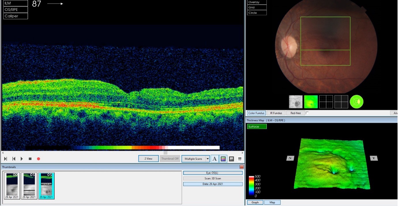 Macula Hole Repair Surgery | Dr Mulonga, Ophthalmologist